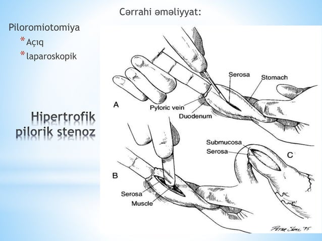 Hipertrofik pilorik stenoz | PPT