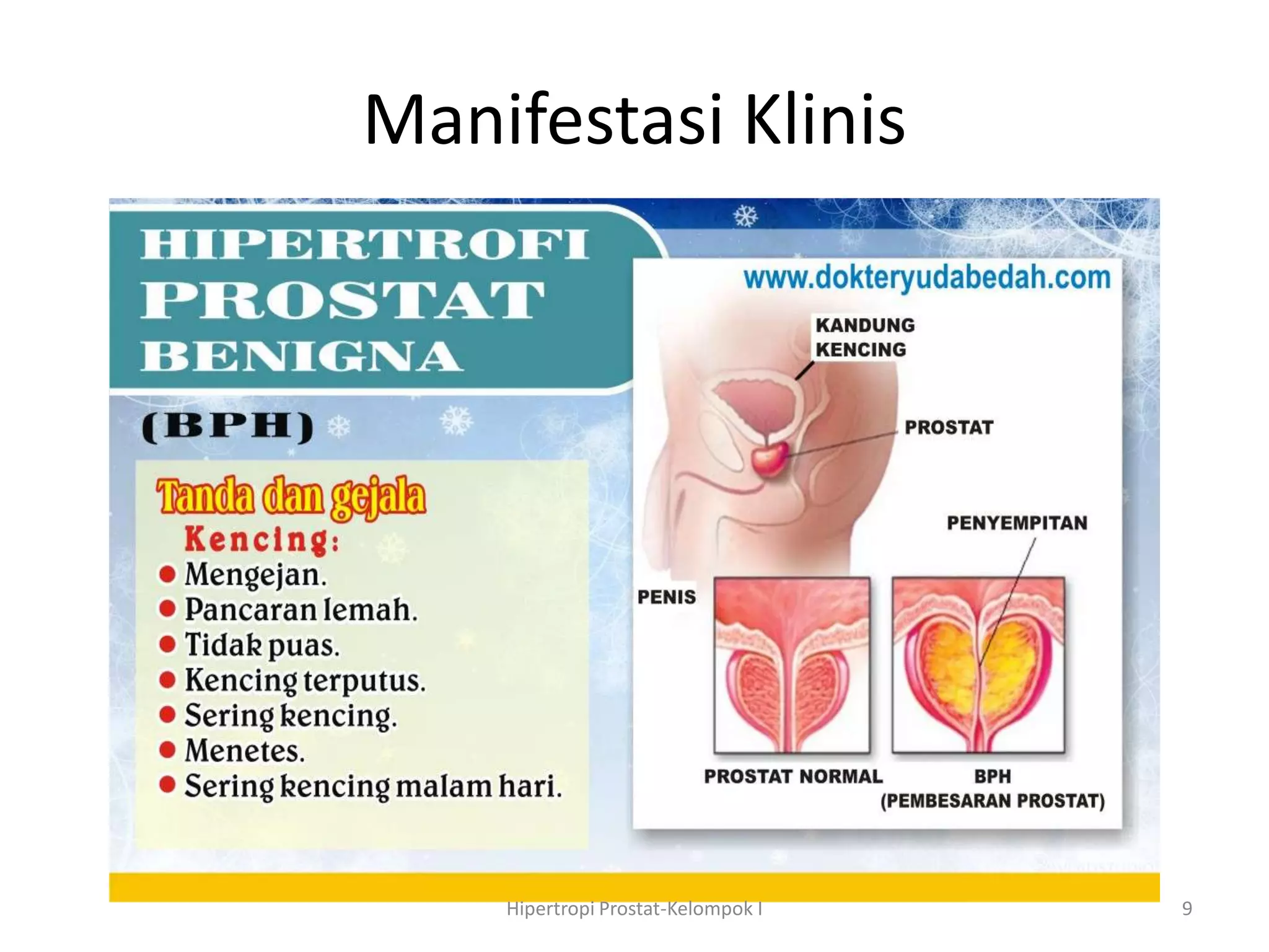 Hipertropi prostat | PPTX