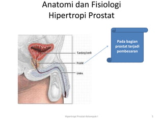 Hipertropi prostat | PPTX