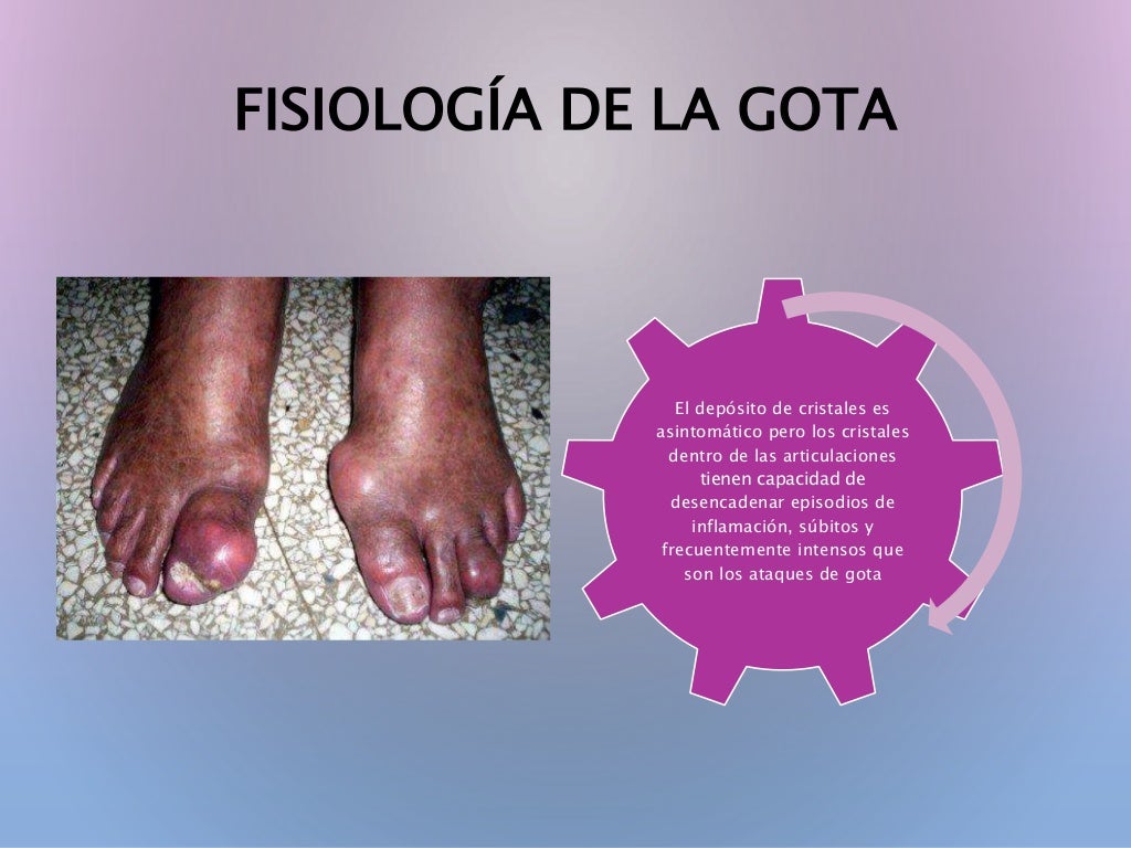 Hiperuricemia y Gota