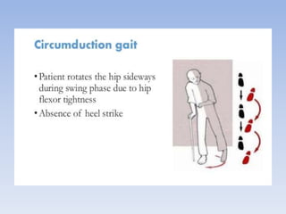 Circumduction Of Hip