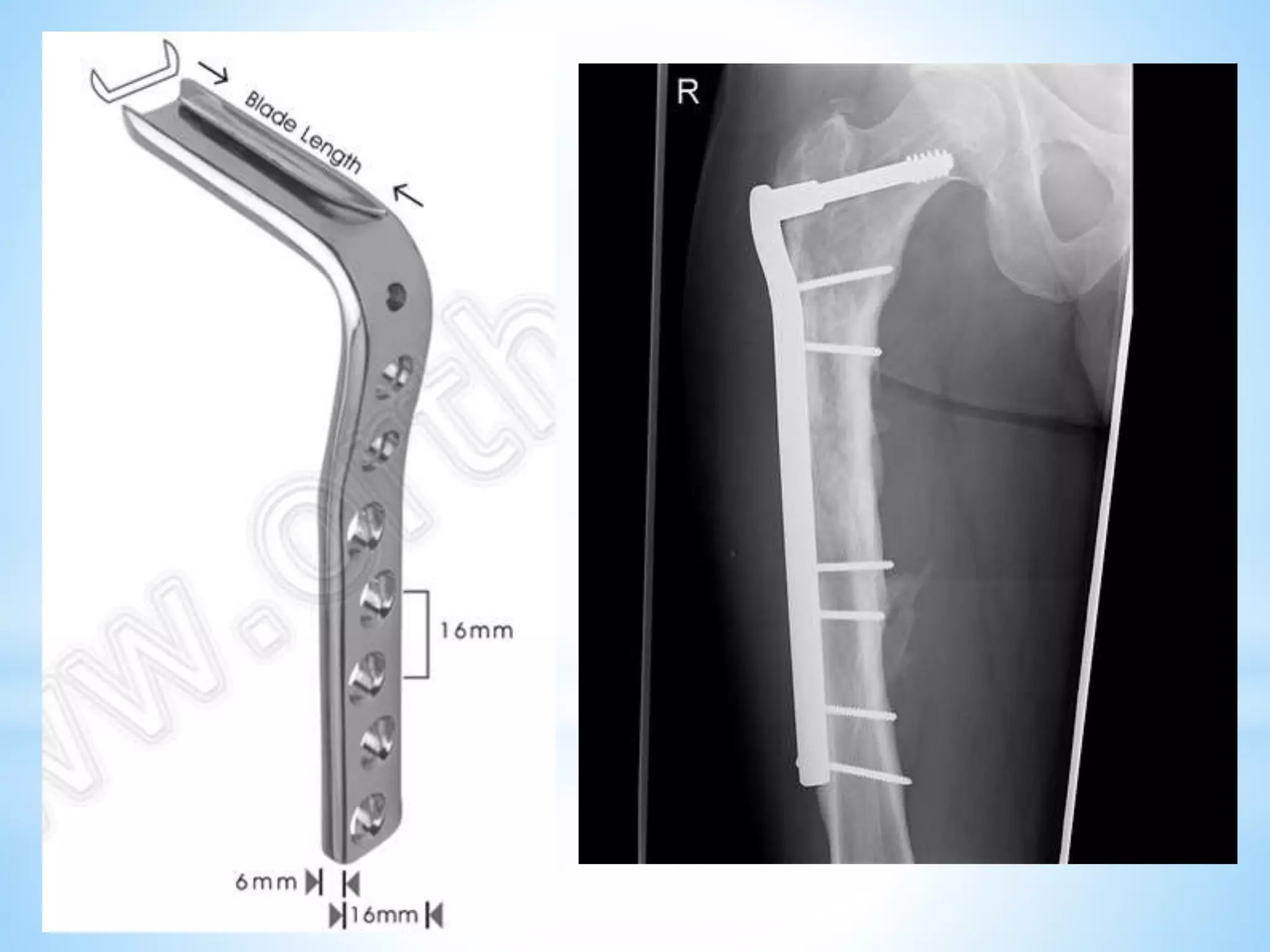 Hip fixation | PPTX