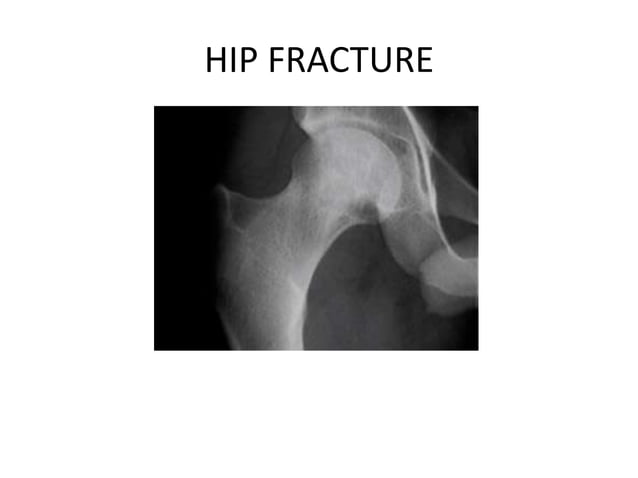 Hip fracture | PPTX
