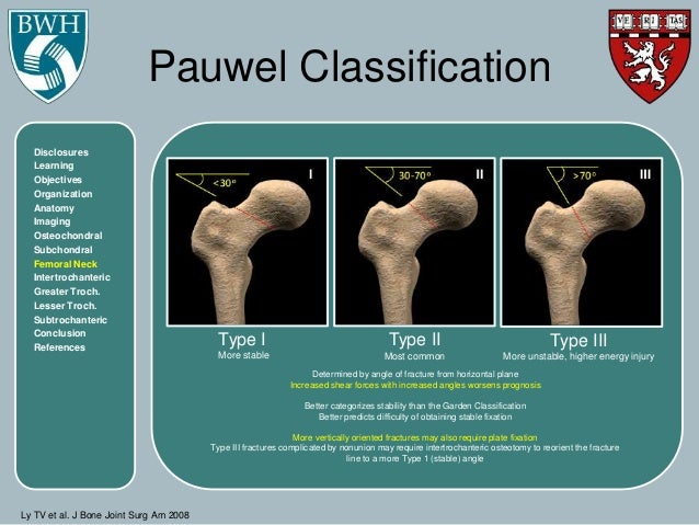 Proximal Femur Fractures - by Jeffrey Shyu, MD