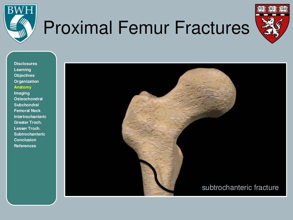 Proximal Femur Fractures - by Jeffrey Shyu, MD