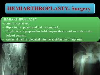 Hip fractures | PPTX