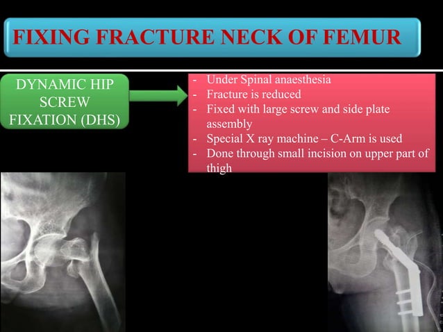 Hip fractures | PPT