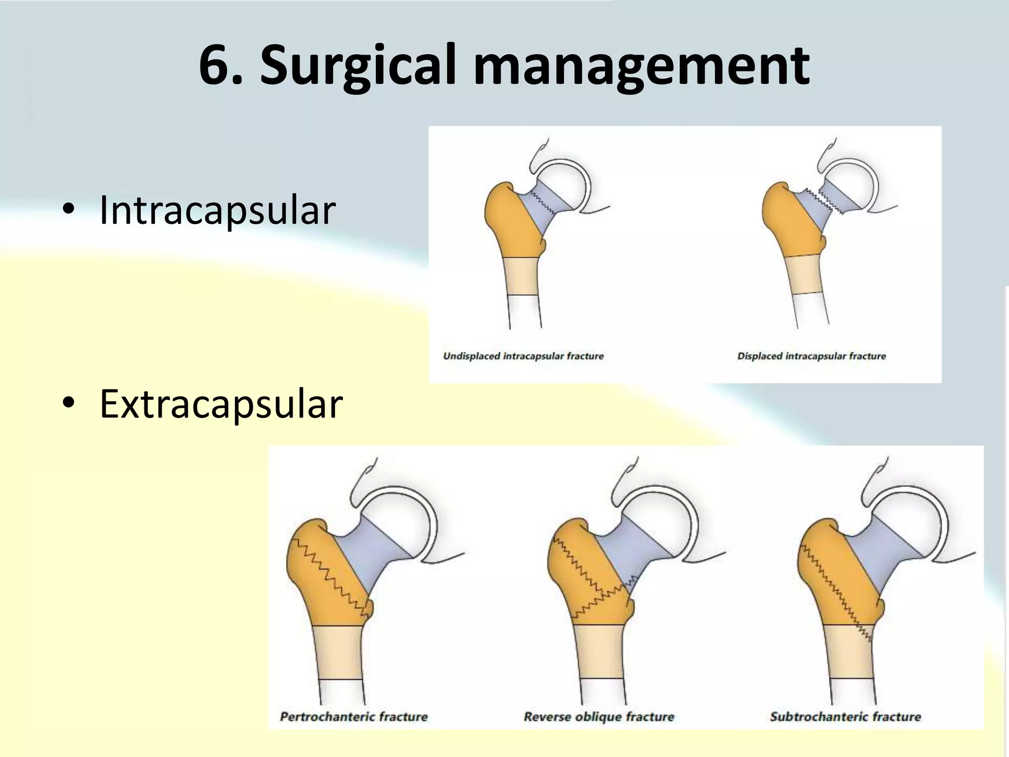 Hip fracture syndrome | PPTX