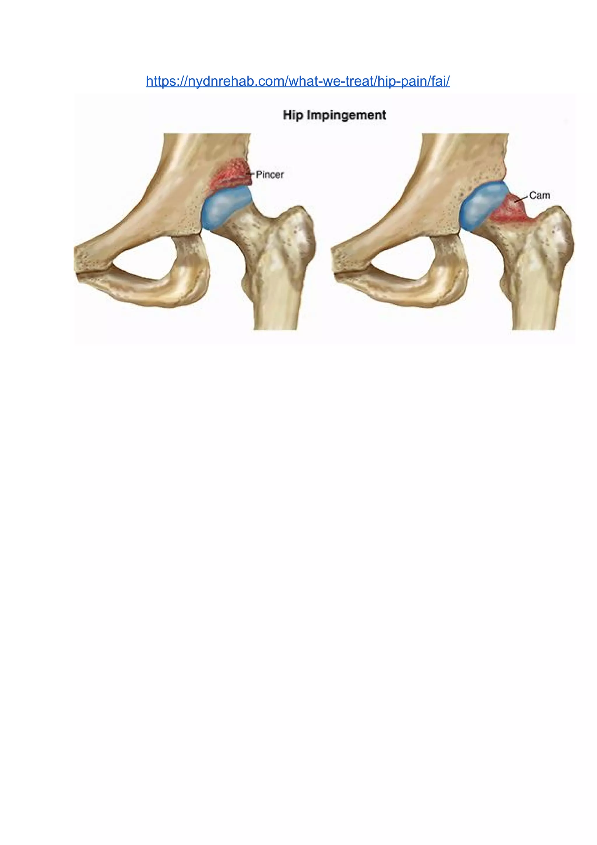 Hip impingement fai | PDF