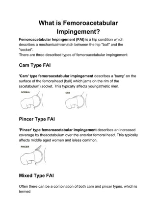Hip impingement fai | PDF