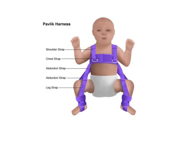 Hip instability in newborn ddh (ug) | PPT | Free Download