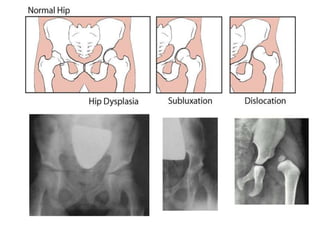 Hip instability in newborn ddh (ug) | PPTX