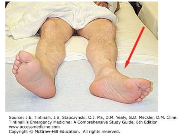 FRACTURE NOF AND INTER-TROCHANTRIC
