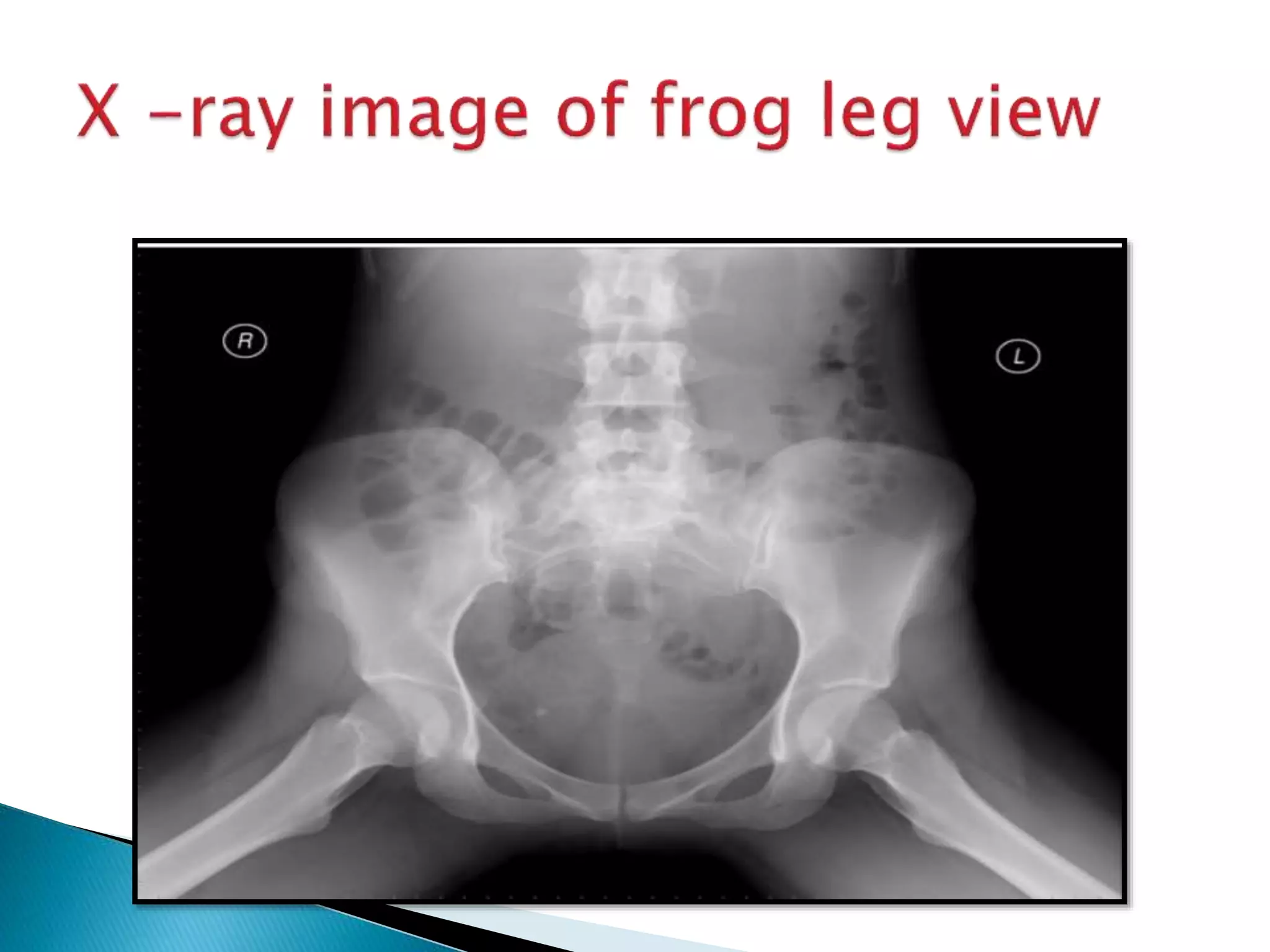 RADIOGRAPHIC VIEWS FOR HIP JOINT | PPTX | Death, Injury, or Military ...