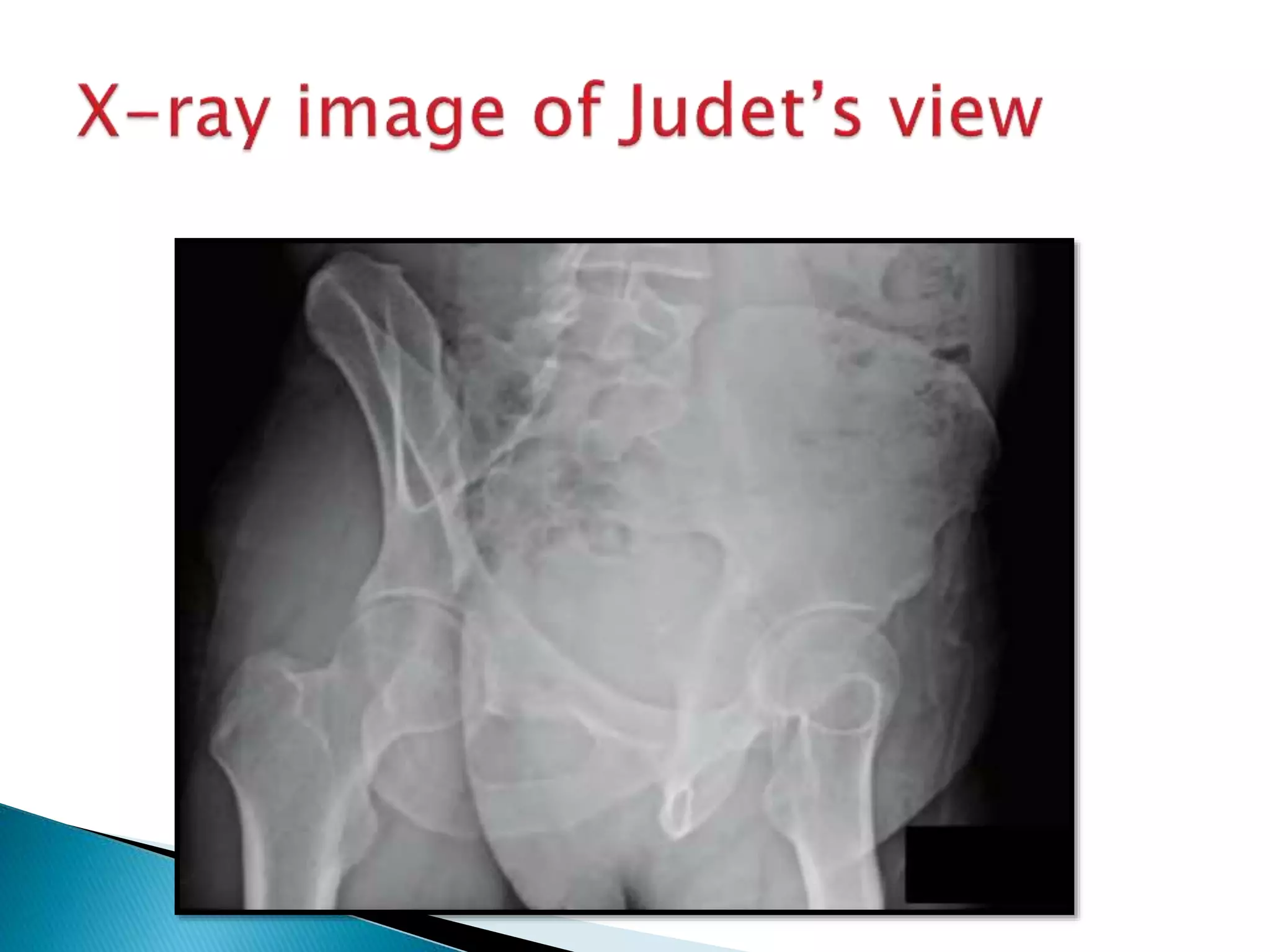 RADIOGRAPHIC VIEWS FOR HIP JOINT | PPTX | Death, Injury, or Military ...