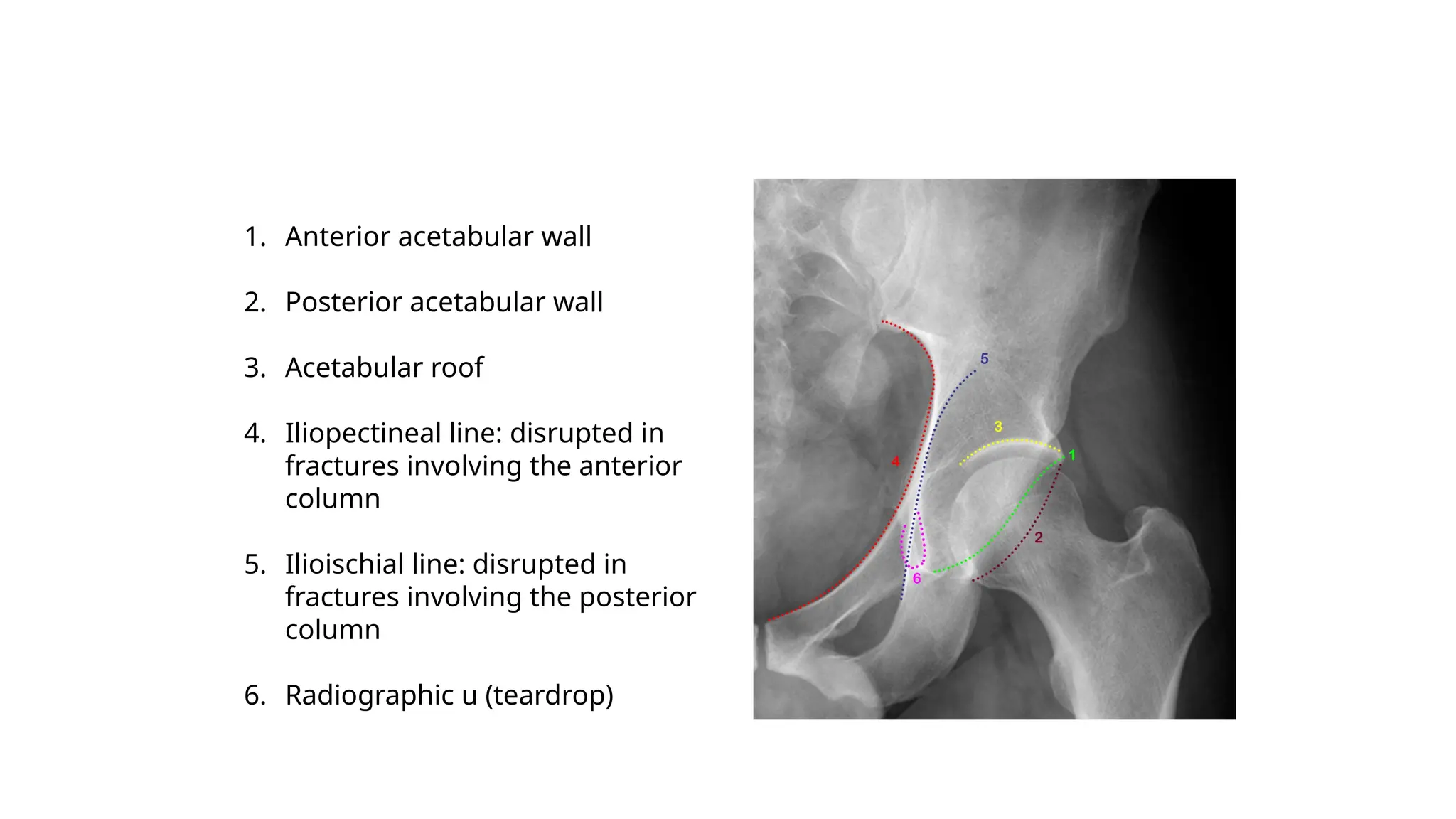 Hip Joint in radiology basics and advanced | PPTX