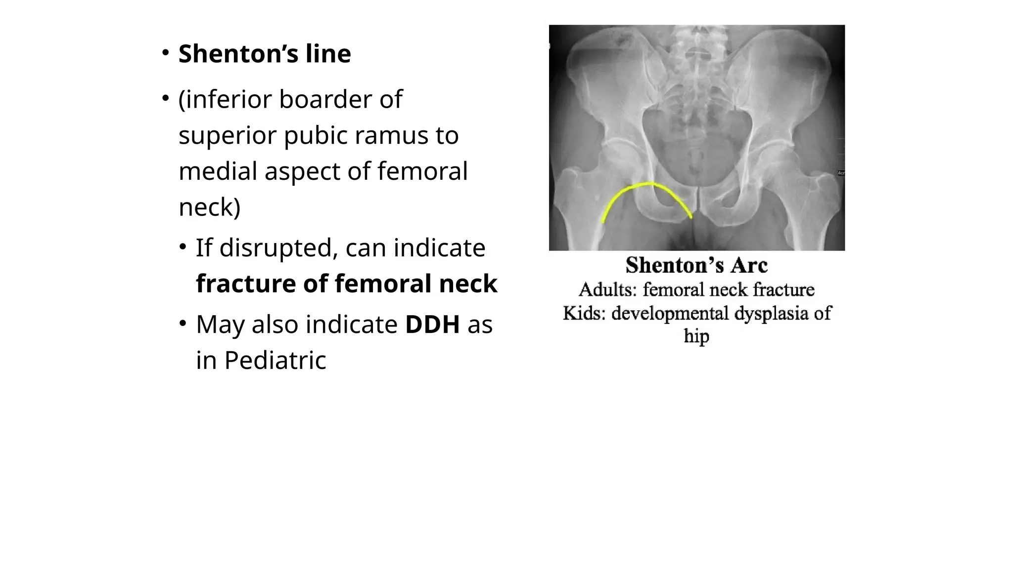 Hip Joint in radiology basics and advanced | PPTX