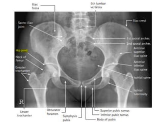 ANTERO-POSTERIOR –PELVIS (basic projection) AND BOTH HIPS (basic ...