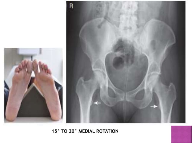 ANTERO-POSTERIOR –PELVIS (basic projection) AND BOTH HIPS (basic ...