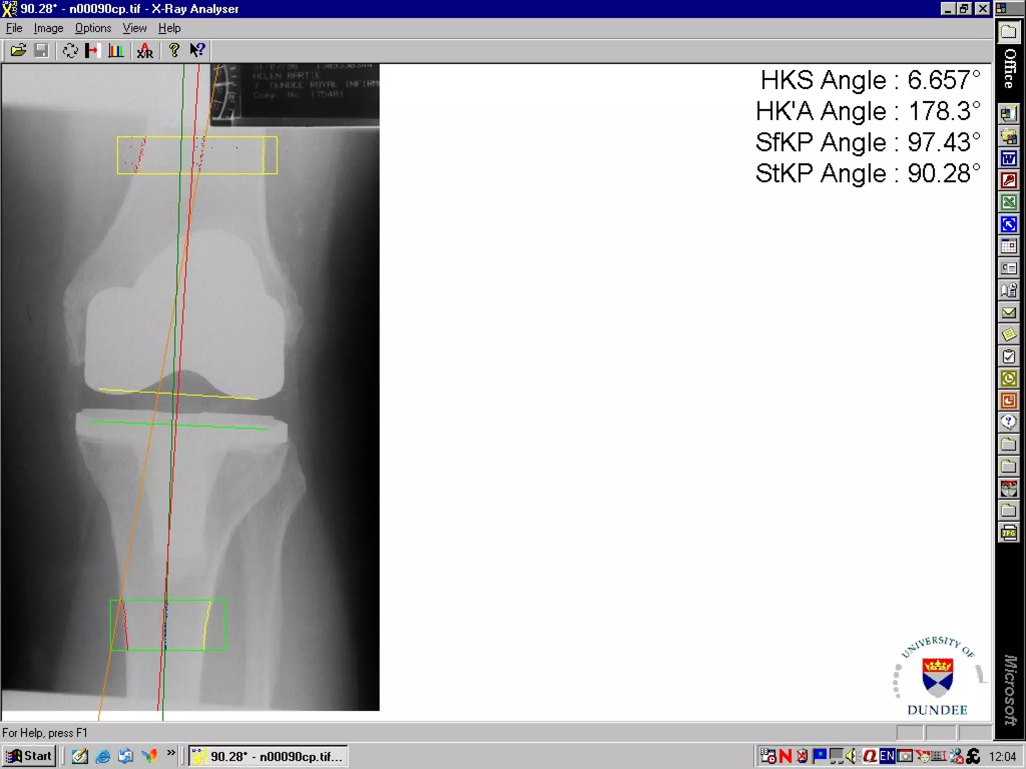 Hip knee condylar angle | PPT