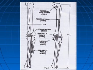 Hip knee condylar angle | PPT | Bone and Joint Conditions | Diseases ...