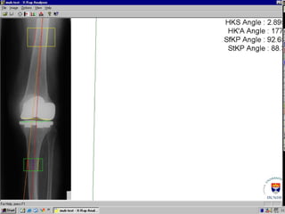 Hip knee condylar angle | PPT