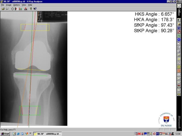 Hip knee condylar angle | PPT