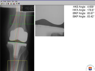 Hip knee condylar angle | PPT | Bone and Joint Conditions | Diseases ...