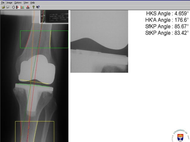 Hip knee condylar angle | PPT