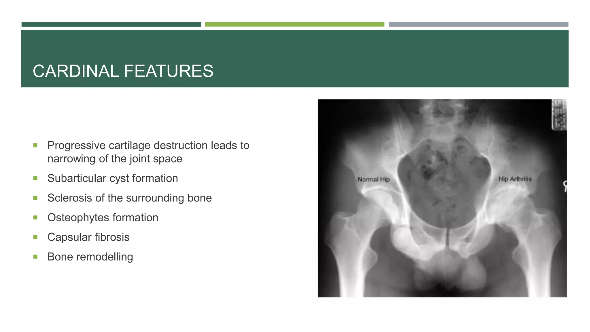 Hip osteoarthritis | PPTX