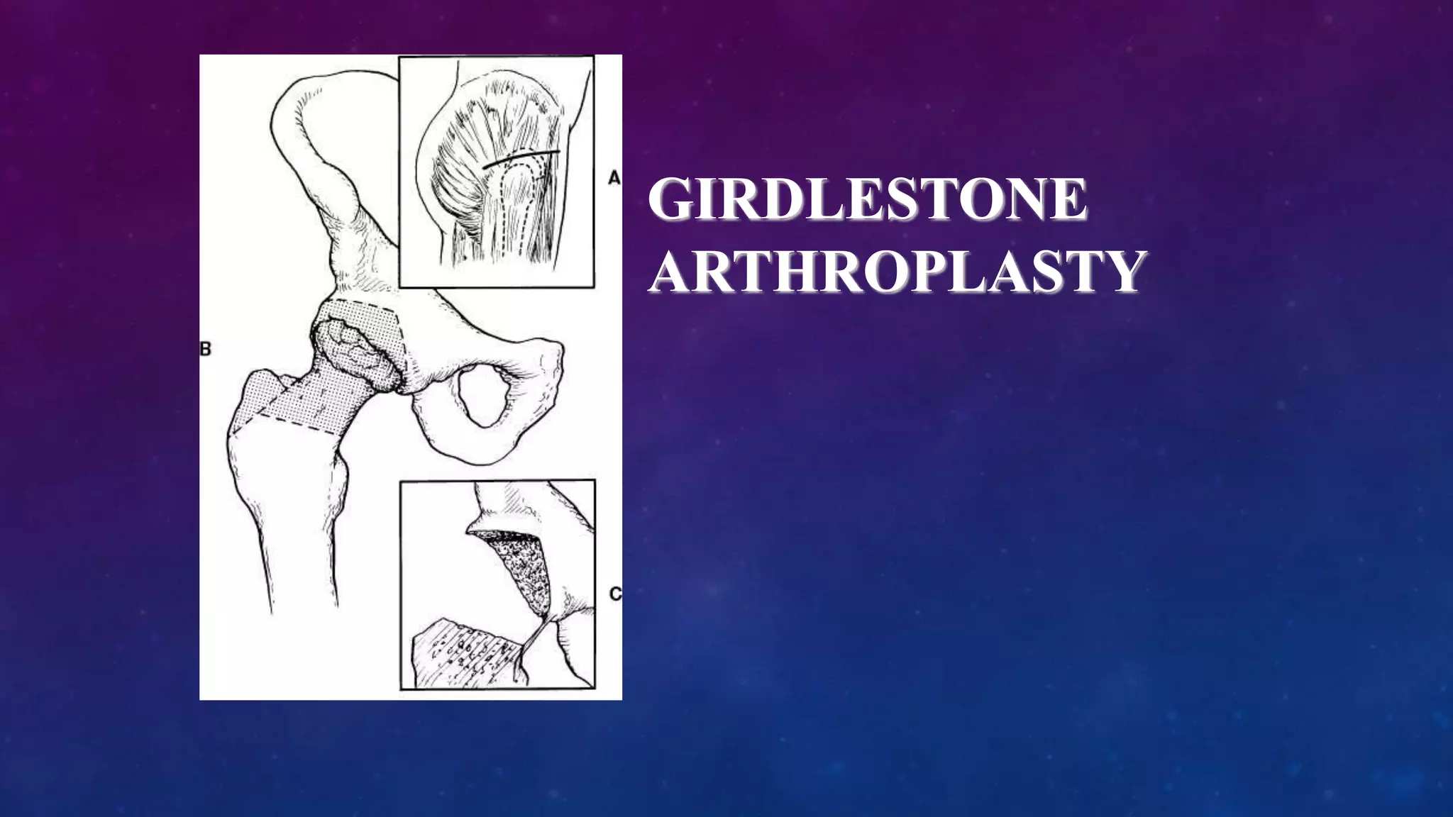 Hip Osteoarthrosis -PAWAN | PPTX