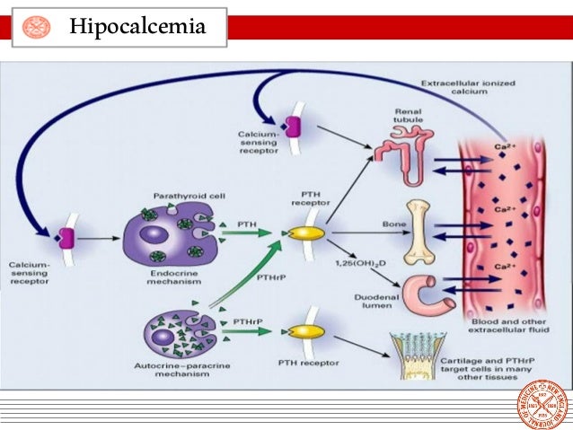 Hipocalcemia