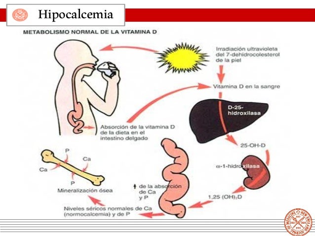 Hipocalcemia