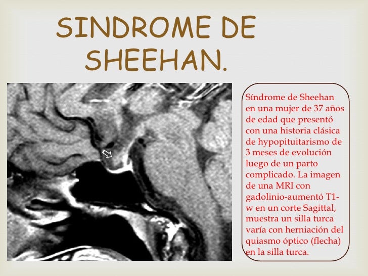 Hipofuncion hipofisaria