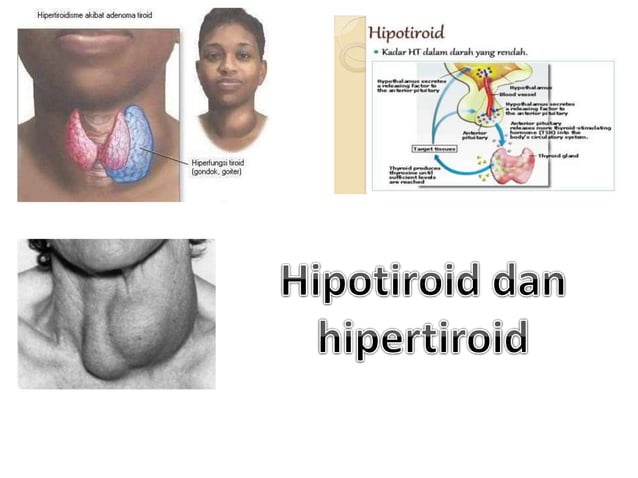 Hipo & Hipertiroid | PPTX