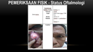 Mini Case_Diagnosis dan Tatalaksana Hipopion | PPTX