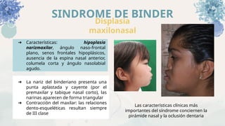 hipoplasia-de-tercio-medio: otorrinolaringología | PPTX