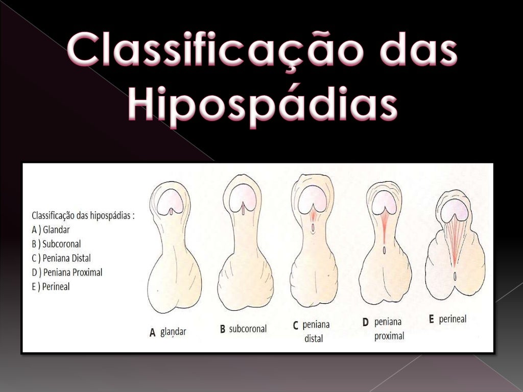 Hipospádia