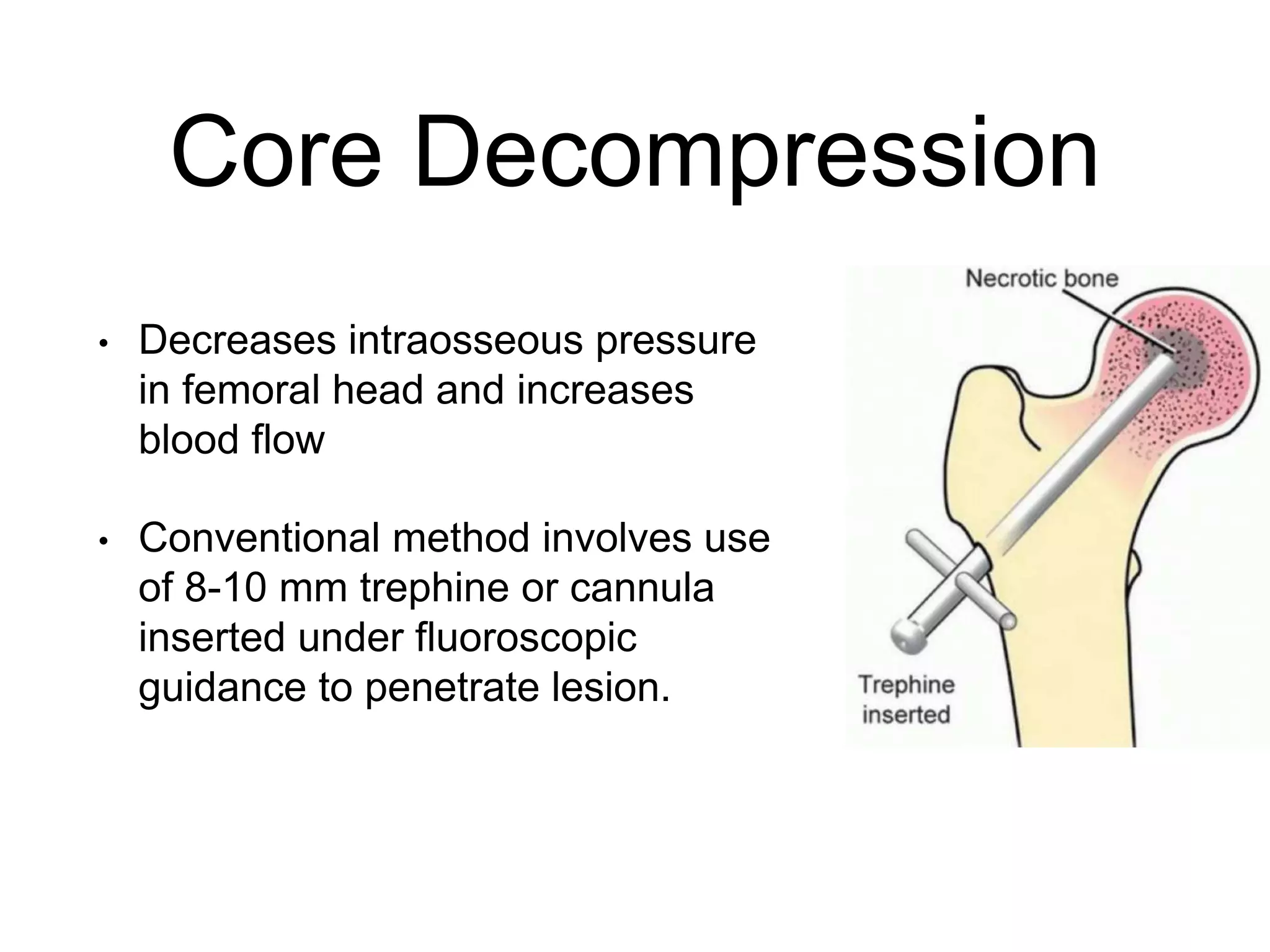 Avascular Necrosis of Hip | PPTX