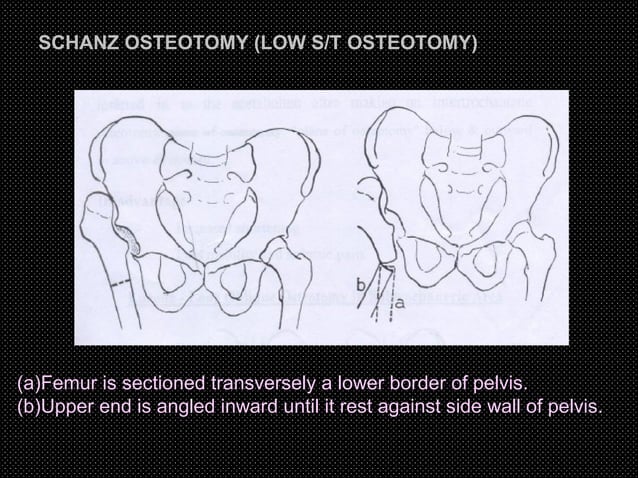 osteotomies around hip | PPT