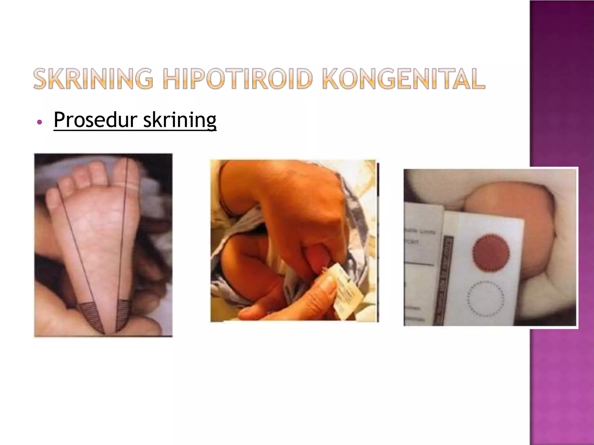 hipotiroid-kongenital-ppt.pptx