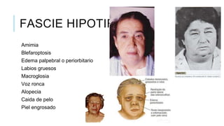 Hipotiroidismo | PPTX