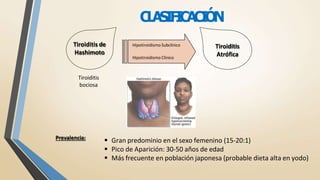 HIPOTIROIDISMO CASO CLINICO.pptx