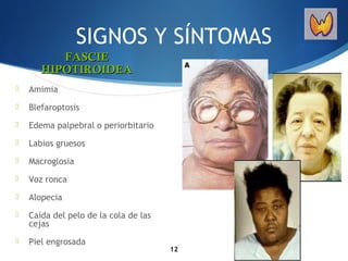 Hipotiroidismo endocrino 2013 | PPT