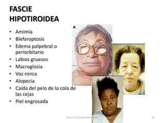 Hipotiroidismo | PDF