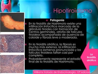 Hipotiroidismo | PPTX