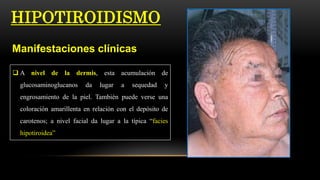NEFROLOGIA CLINICA: Hipotiroidismo y enfermedad renal cronica | PDF