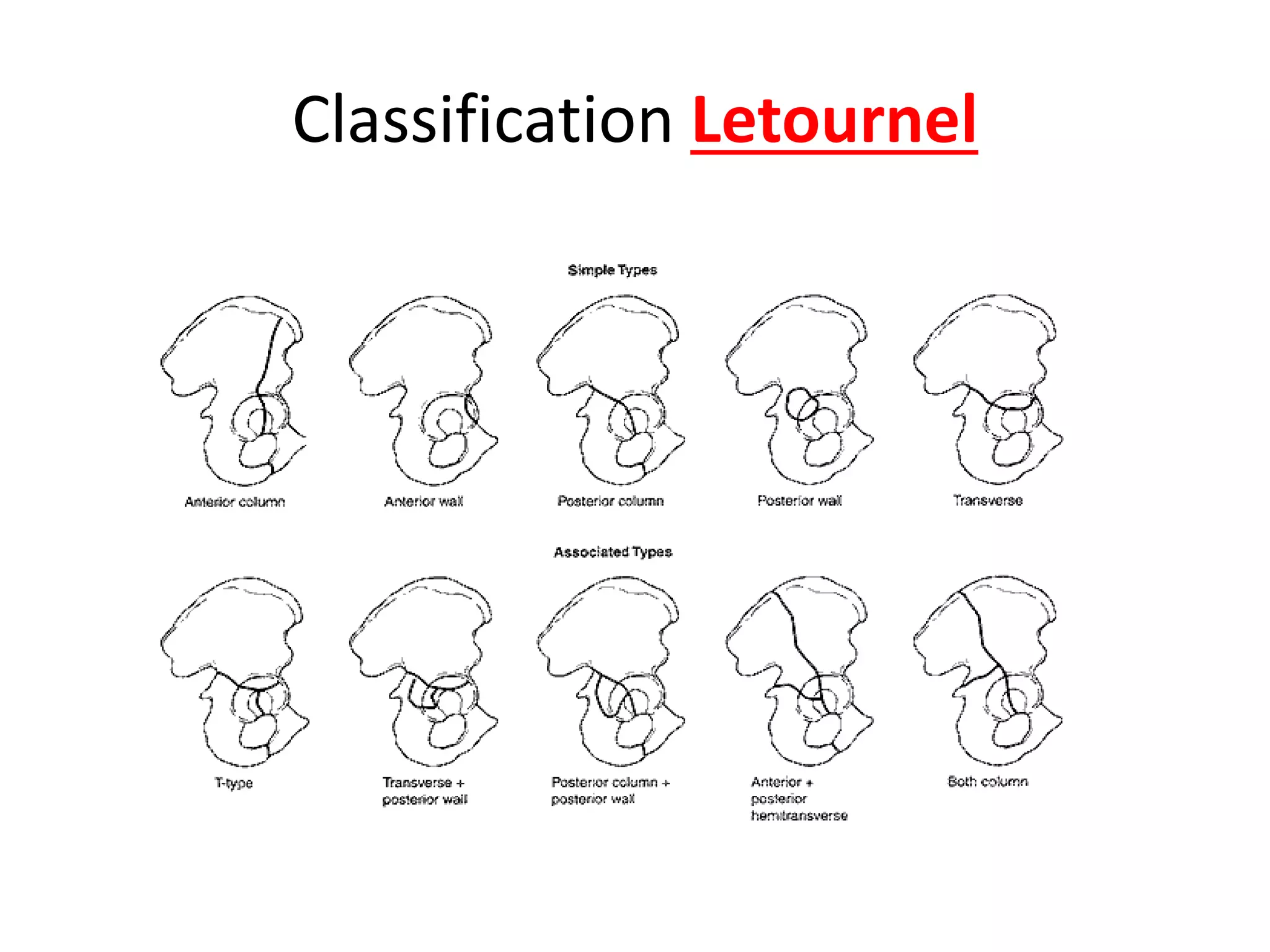 Hip Periprosthetic Fracture.pptx