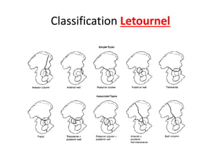 Hip Periprosthetic Fracture.pptx