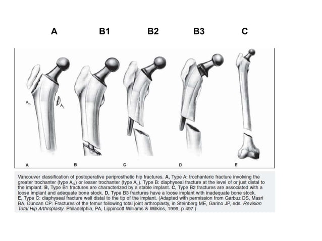 Hip Periprosthetic Fracture.pptx